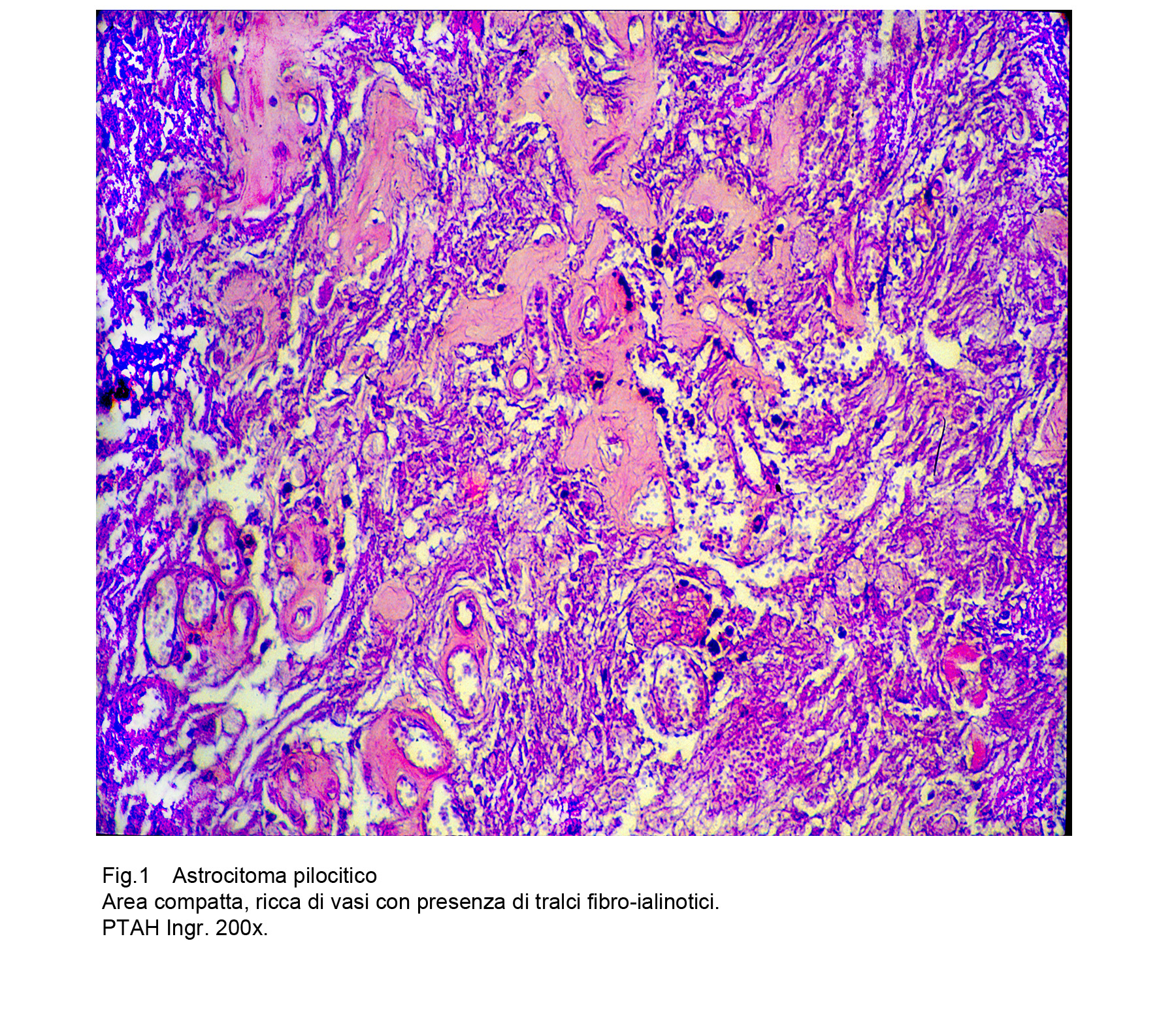 astrocitoma pilocitico