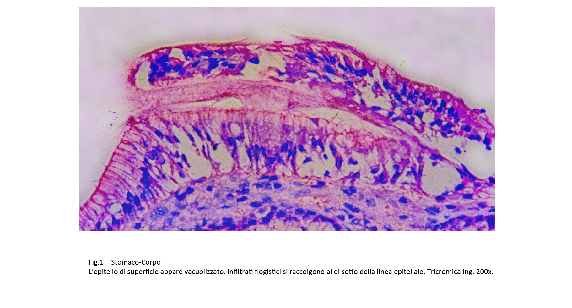 gastrite cronica da helicobacter-pilory