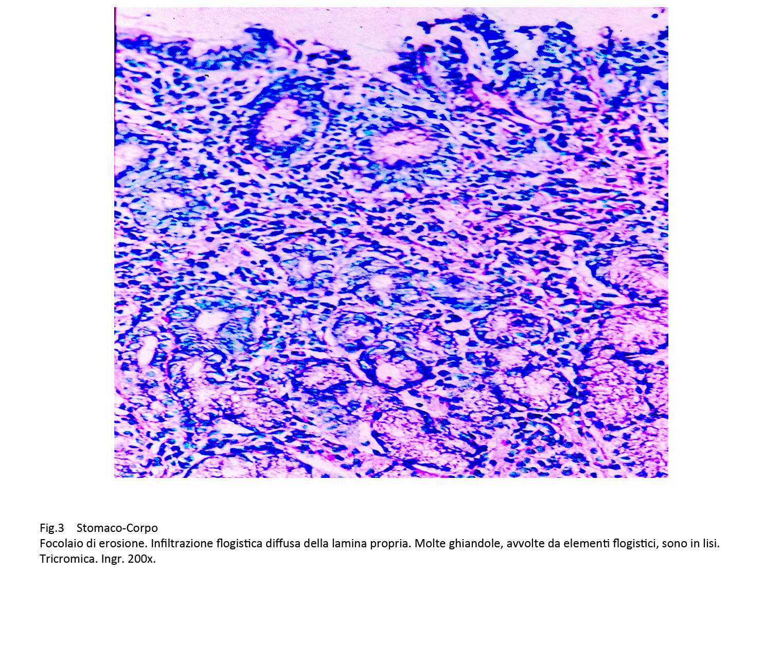 gastrite cronica da helicobacter-pilory
