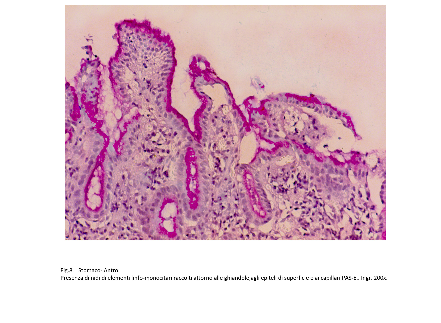 gastrite cronica da helicobacter-pilory
